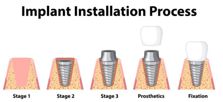A Step-by-Step Guide on the Procedure for Dental Implants – Taste Orange